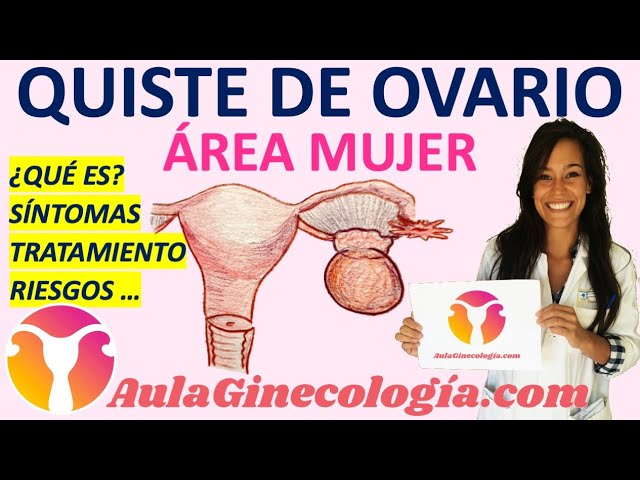 Todo lo que Necesitas Saber sobre la Extirpación de Quistes Ováricos ...